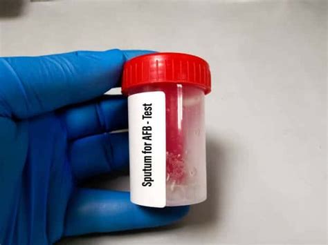 Sputum For Afb Test Mrldc Diagnostic Centre