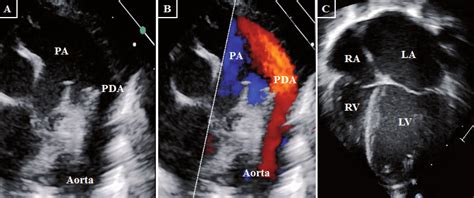 Transthoracic Echocardiogram Tte Demonstrating A Large Hspda In A 3 Download Scientific