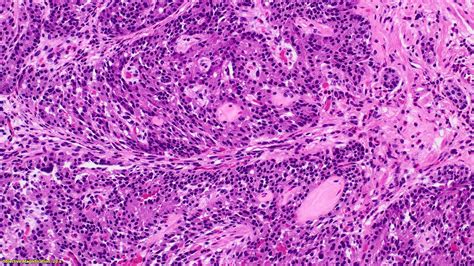 Pathology Outlines Neuroendocrine Tumor