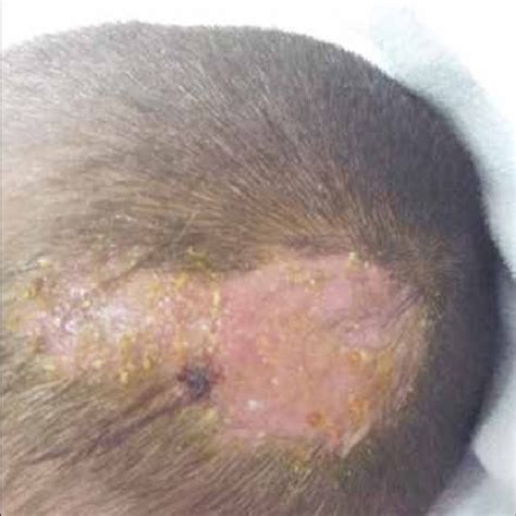 Alopecic Nodular And Pustular Lesions On Hairy Scalp Download