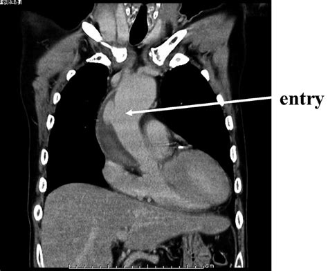 Chest Ct Shows Ascending Aorta Dissection Download Scientific Diagram