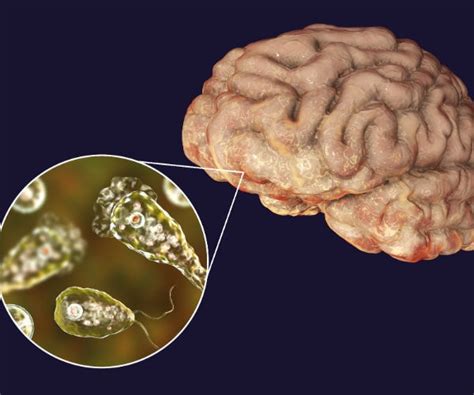 Rare Brain Eating Amoeba Case Reported In Florida