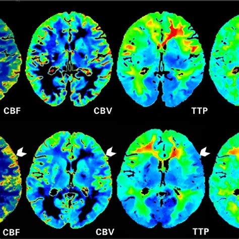 Ctp Images Before Top And After Bottom Sta Mca Of The Same Patient