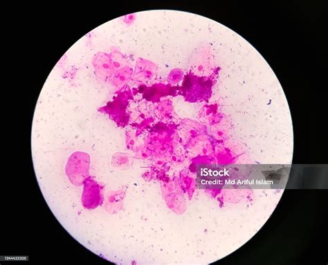 높은 질 면봉 그램 얼룩 현미경 100x는 몇 가지 고름 세포와 상피 세포를 보여줍니다 그램 양성 디플로코치와 몇 그램 네거티브 로드모양 박테리아의 큰 수 외음질염에 대한
