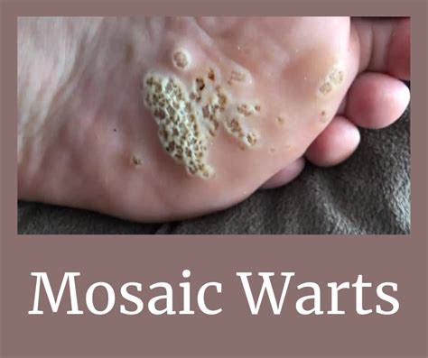 Mosaic Warts Are A Psoriasis Treatment At Psoriatreat Facebook