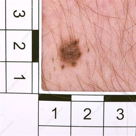 Mole Diagnosis Stock Image C0382289 Science Photo Library Mole Diagnosis Stock Image C0382289 Science Photo Library