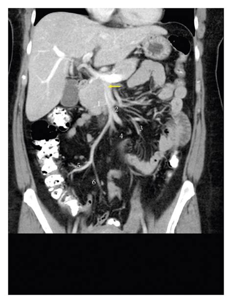 Ramifications Of The Superior Mesenteric Artery Arrow Include The