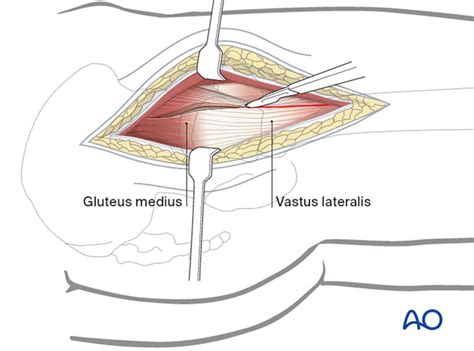 Direct Lateral Approach To The Proximal Femur