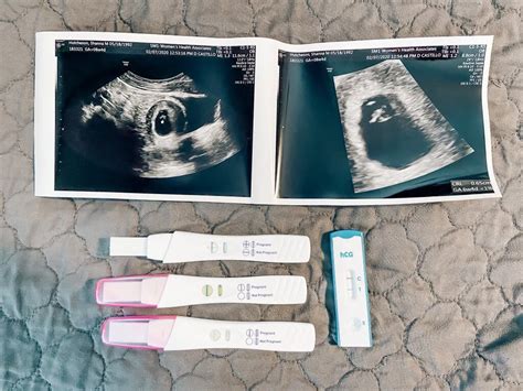 What To Expect During A Miscarriage My Story