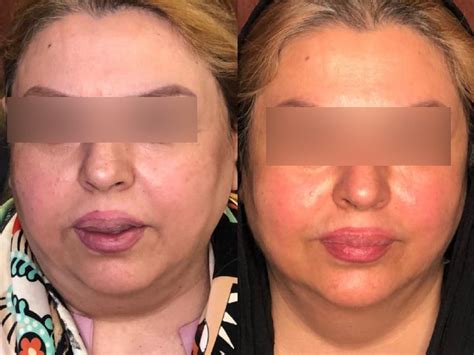 لندینگ اندولیفت دکتر مولایی فر