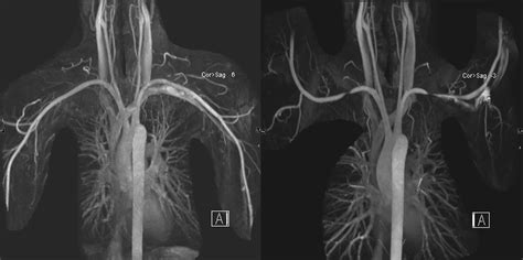 Imaging Assessment Of Thoracic Outlet Syndrome Thoracic Surgery Clinics
