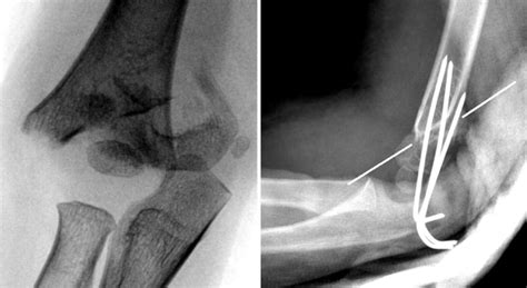 Radiographs Of The Second Case Supracondylar Fracture With A Medial Download Scientific