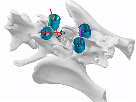 Neurology Team Uses Novel Implants For Spinal Care Ndsr