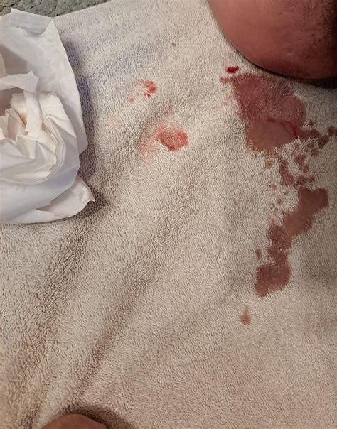 Aftermath Photos Of An Abscess Draining Rpopping