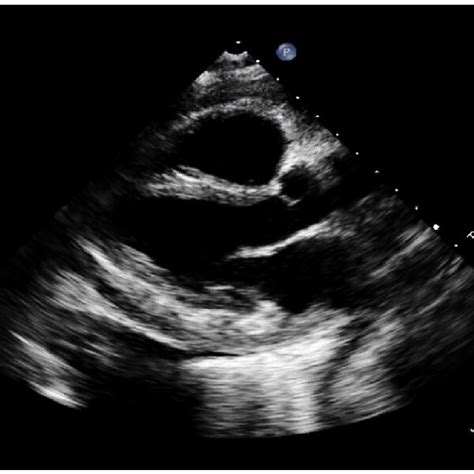 Echocardiography Shows Markedly Thickened Pericardium And Abnormal Soft