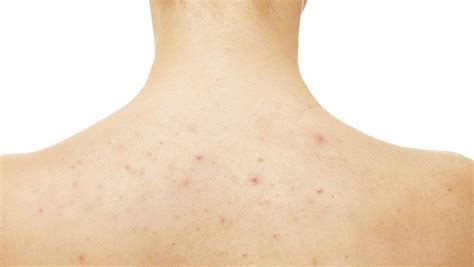 Is Folliculitis Contagious Vinmec