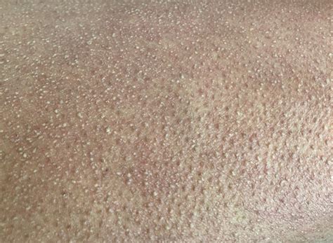 Pustulosis Exantemática Generalizada Aguda Secundaria A Loxoscelismo