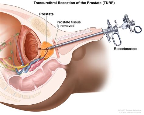Definition Of Transurethral Resection Of The Prostate Nci Dictionary