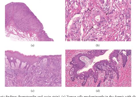 Figure 2 From Apocrine Adenocarcinoma Of The Vulva A Case Report And
