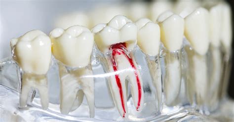 Advances In Endodontic Irrigation Techniques