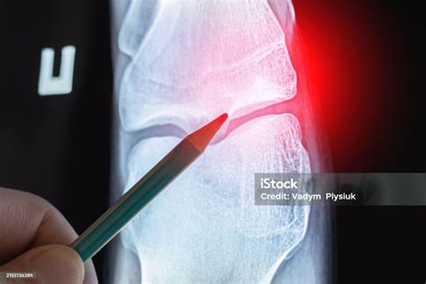 Doctor Examining Osteoid Osteoma Benign Bone Tumor Xray And Mri Mrt Ct
