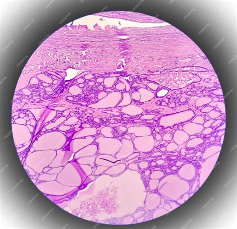 Premium Photo Synovial Sarcoma Histology Image Analyzed By Microscope