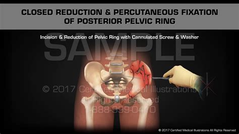 Pelvic External Fixation