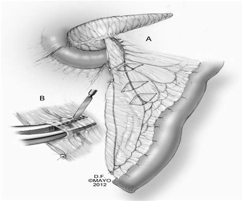 Robotic Platform For An Ipaa Diseases Of The Colon And Rectum