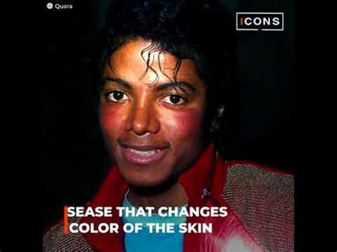 Michael Jacksons Vitiligo Youtube