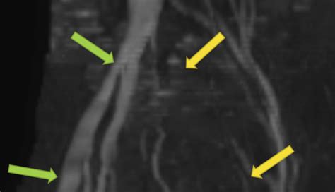 Venous Claudication Post Iliofemoral Dvt Michael Cumming Md Mba