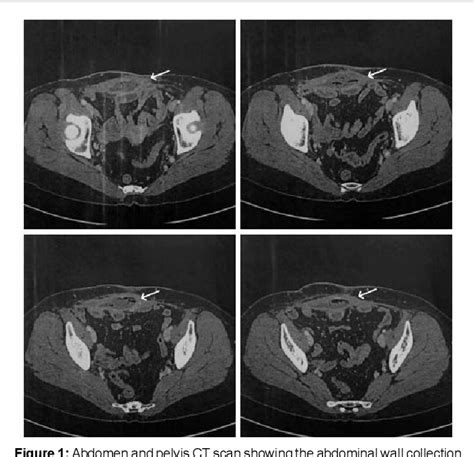 Figure 1 From Isolation Of Streptococcus Thoraltensis From An Abdominal Wall Abscess In A Young