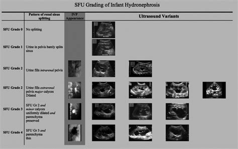 The Society For Fetal Urology Consensus Statement On The Evaluation And
