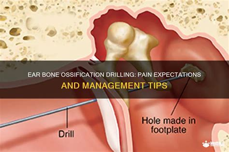 Ear Bone Ossification Drilling Pain Expectations And Management Tips