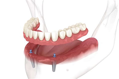Implant Supported Dentures Maxillary