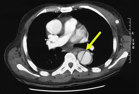 Aortic Dissection A Double Barreled Threat
