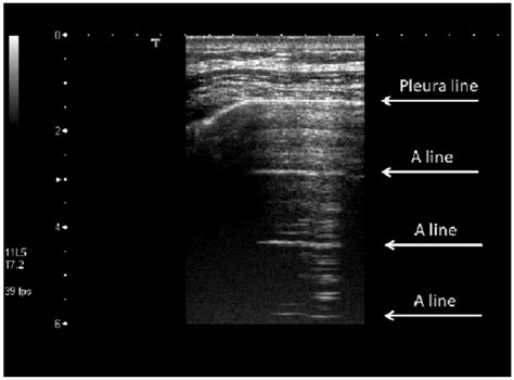 B Lines Lung Ultrasonography Simulation Using Finite Element Method
