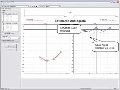 Auditory Steady State Response Assr A Beginners Guide The Hearing