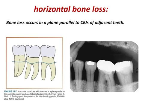 Interpretation Of Periodontal Disease Ppt Download