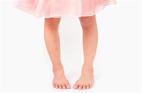 Kaki O Genu Varum Gejala Penyebab Dan Pengobatan Halodoc