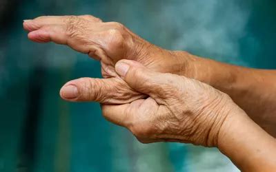 Gout In Hands Symptoms Causes And Treatment