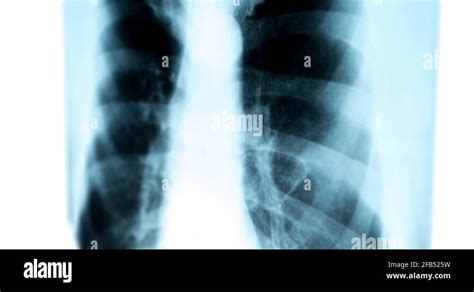 X Ray Of The Chest On The Light Screen Scrolling Down Stock Video Footage Alamy