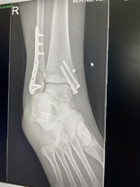 Broken Tibia And Fibula And Torn Ligaments R Brokenbones