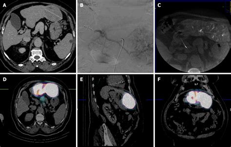 Selective Internal Radiation Therapy Segmentectomy A New Minimally Invasive Curative Option For