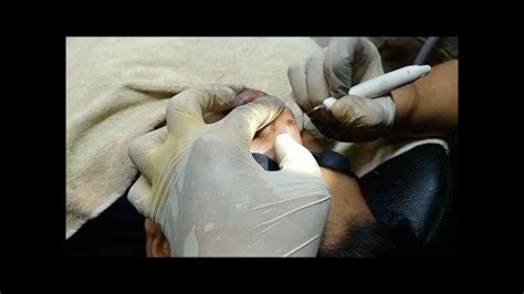 লেজার মেশিন দ্বারা মুখের দাগ তিল আঁচিল কাটা দাগ জন্মদাগ মের্সতা ব্রুনের দাগ ট্যাটু রিমুভ করা হয়