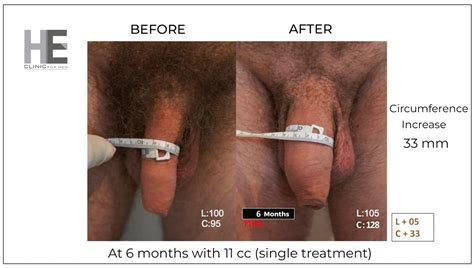 Before After Pictures Penis Enlargement Male Enhancement Clinic Bangkok