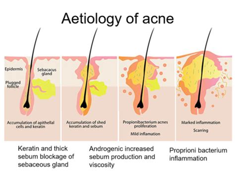 Acne Vulgaris Flashcards Quizlet
