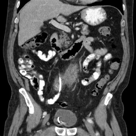 Retroperitoneal Fibrosis