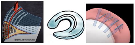 Meniskskader Kristiansand Fysioterapi