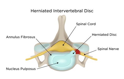 Lumbosacral Radiculopathy Sciatica My Doctor Online