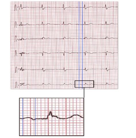 An Example Of Advanced Interatrial Block A Iab P Wave Duration ≥120 Download Scientific